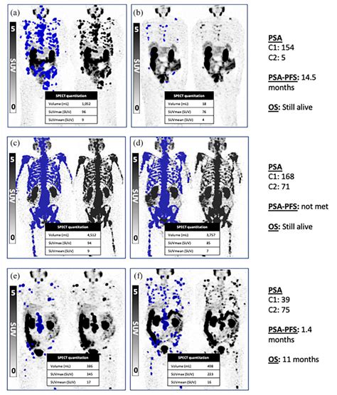 Imaging Pr Between Baseline ¹⁷⁷lu Spect A And Week 6 B Imaging Sd