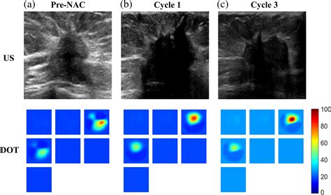Ultrasound And Diffuse Optical Tomography Transformer Model For