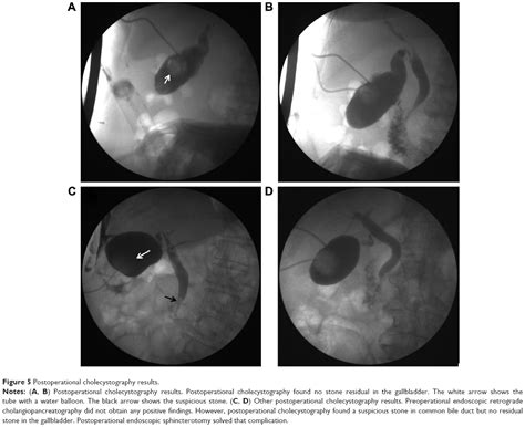 Risk Factors For Gallbladder Contractility After Cholecystolithotomy I