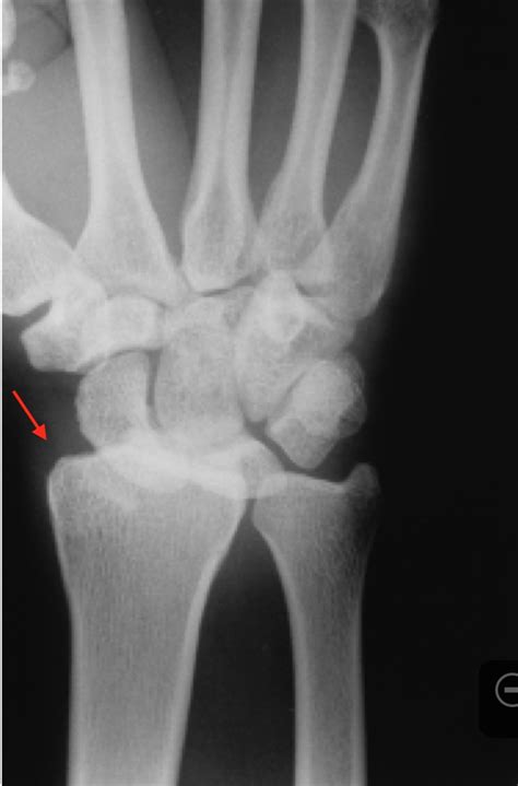 Radiocarpal Fracture Dislocation Hand Orthobullets