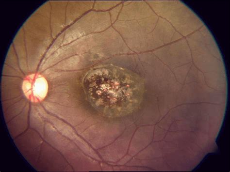 Toxoplasmic Chorioretinitis Wikiwand