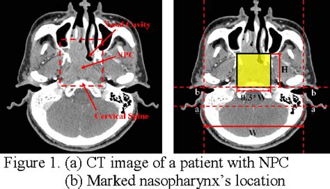 Figure 1 From Automatic Segmentation Of Nasopharyngeal Carcinoma From Ct Images Semantic Scholar
