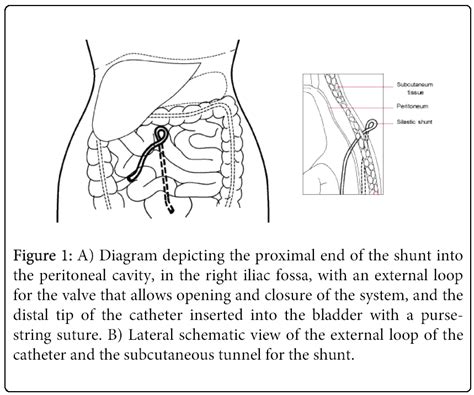 About The Procedure Lumboperitoneal Shunts Milerh
