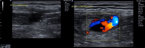 Doppler Ultrasound After Unsuccessful Probe Compression Download Scientific Diagram