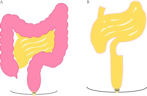 Proctocolectomy [a] And Ileal Pouch Anal Anastomosis [b] Download Scientific Diagram