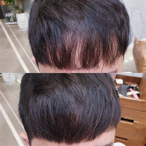 비비드 헤어 ️부족한 머리숱⁉️ ⚜헤어증모술🔱 ㆍ ㆍ 모발이식도 한번 했었지만 갈라지는 앞머리 증모술로 ㆍ ㆍ 창원증모술 창원헤어증모술 창원남자붙임머리 창원남자증모술