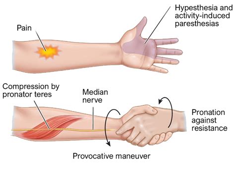 Pronator Teres Syndrome The Pronator Teres Nerve Entrapment Syndrome