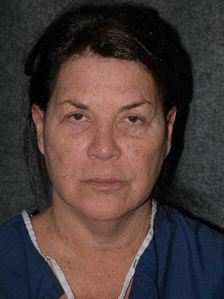 Blepharoplasty Before And After Patient 22