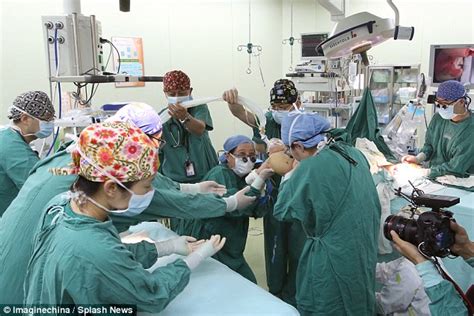 Chinese Conjoined Twins Separated In Operation Using D Printing Technology Daily Mail Online
