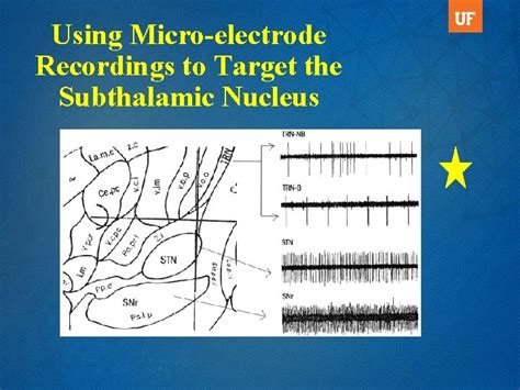 Making Dbs Microelectrode Recordings Mer Simple Adolfo Ramirezzamora