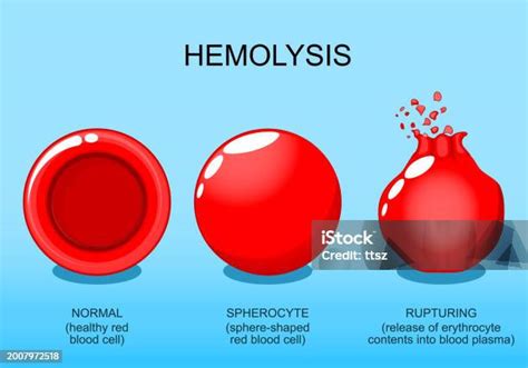 Hemolisis Sel Darah Merah Normal Spherocyte Dan Pecahnya Eritrosit
