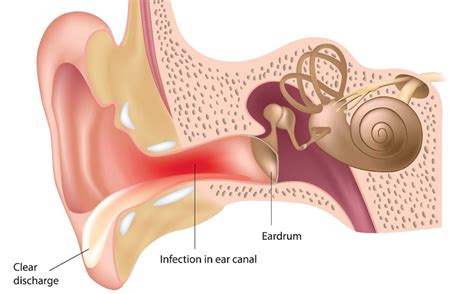 Surfers Ear Explained Everything You Need To Know About Exostosis