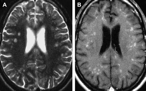 Imaging Of Acute Disseminated Encephalomyelitis Neuroimaging Clinics