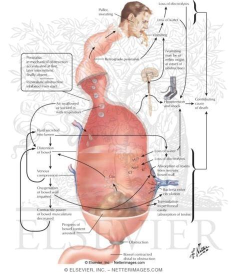 Intestinal Obstruction Adynamic Ileus