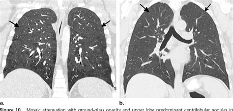 Figure 10 From Mosaic Attenuation Etiology Methods Of Differentiation