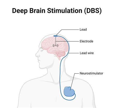 deep brain stimulation dbs biorender science templates