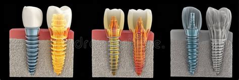 3d Simulation Illustrates Implant Osseointegration Process Over Time With Multiple Time Steps