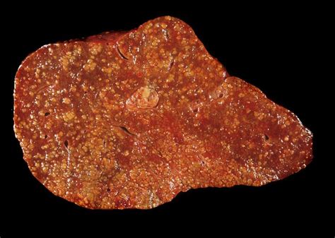 Рак Печени Симптомы Фото —