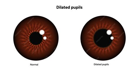 Premium Vector Dilated Pupils Eye Diseases Ophthalmology