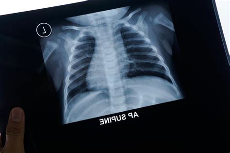 Short Course Antibiotic Therapy Enough For Paediatric Outpatient Cap