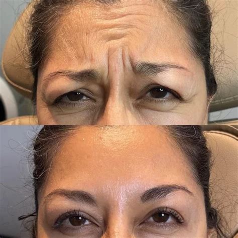 Forehead Botox Comprehensive Guide Suddenly Slimmer Med Spa