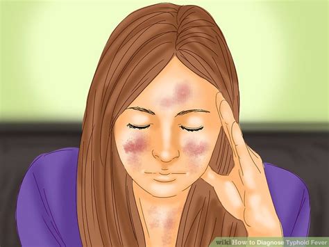 how to diagnose typhoid fever 10 steps with pictures wikihow health