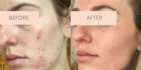 Everything You Need To Know About Chemical Peels Dr Nerina Wilkinson