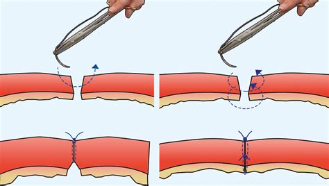 Single‐layer Uterine Closure Excluding The Endometrium Left And Download Scientific Diagram