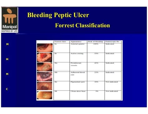 Upper Gi Hemorrhage Surgical Perspective