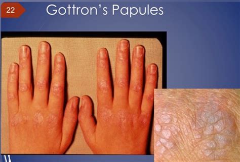 6 Inflammatory Muscle Disease Polymyositis And Dermatomyositis