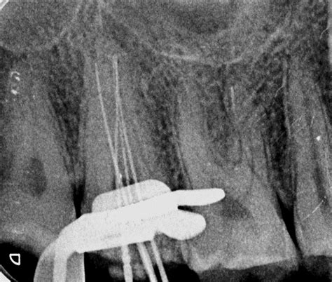 Radiograph To Determine The Working Length Download Scientific Diagram