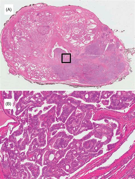 Prostatic Utricle Histology