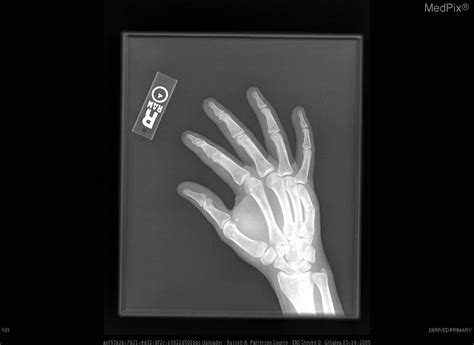Metacarpal Neck Fracture