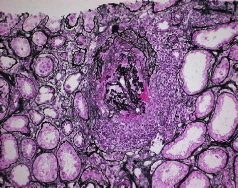Light Microscopy Picture Of A Renal Biopsy From A Patient With Anca