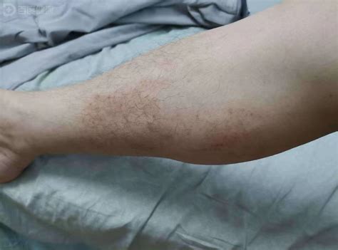 小腿部位红斑、瘙痒，小腿皮炎在作怪 医疗科普 百度健康