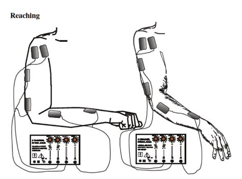 Electrode Placement Elbow Flexion At Hudson Slattery Blog