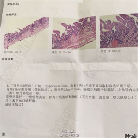 胃早癌内镜下esd治疗 医联