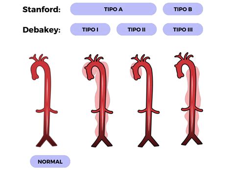 Classificação De Stanford E Debakey Para A Dissecção De Aorta Blog De