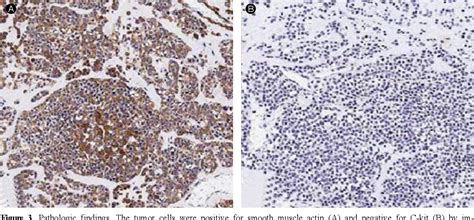 Figure 3 From Glomus Tumor In Stomach 3 Cases Semantic Scholar