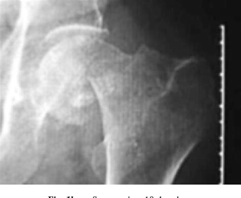 Figure 1 From Misdiagnosis Of Occult Hip Fracture Is More Likely In