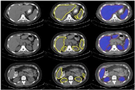 Figure 2 From A Survey Of Graph Cutsgraph Search Based Medical Image Segmentation Semantic