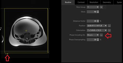 Phase Encoding In Mri Mri Phase Encoding Direction
