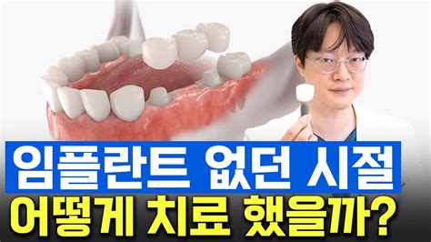 임플란트 없었을 때 치료법과 현재 임플란트와 틀니의 원리 군포 산본 미래플란트치과 김재현 원장 Youtube