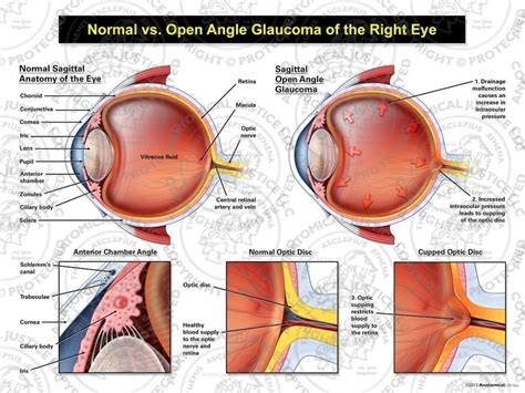 Normal Vs Open Angle Glaucoma Of The Right Eye