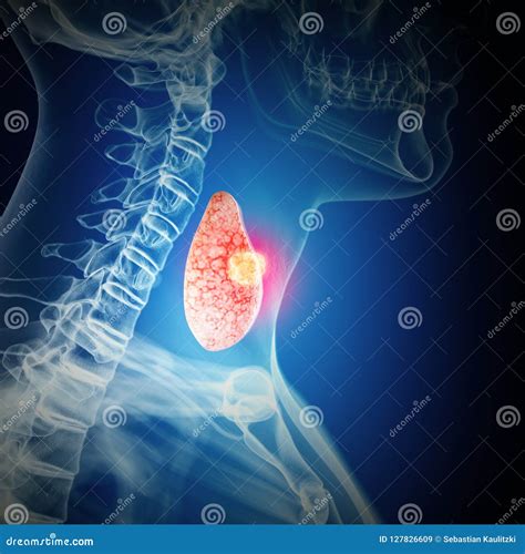 Thyroid Nodule With Fluid At Charles Bolden Blog