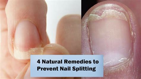4 Natural Remedies To Prevent Nail Splitting Healthy Lifestyle