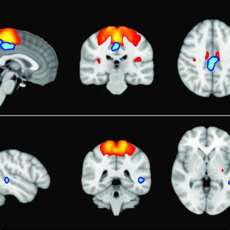 Group Differences In Functional Connectivity A Posterior Cingulate