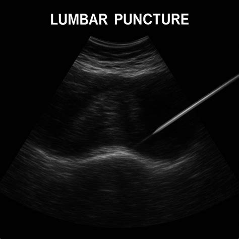 Famus Lumbar Puncture Module Society For Acute Medicine
