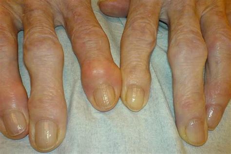 Gout Vs Osteoarthritis Difference And Comparison Diffen