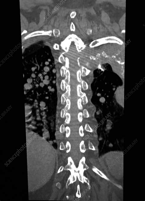 Lung Cancer Ct Scan Stock Image C058 4483 Science Photo Library